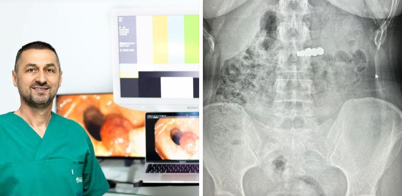 Doktor Besnik Elezi heq me sukses protezën dentare të përfunduar në ...